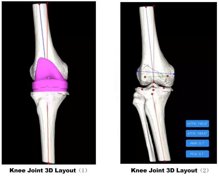 Full-Process Customized Total Knee Replacement Surgery Using 3D ...